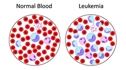 Know the Blood Cancer Treatment Process – My Health